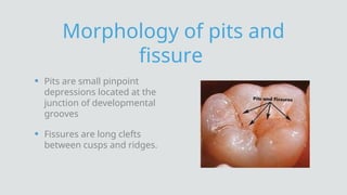Pit and fissure sealants preventive dentistry .ppt