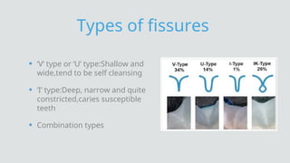 Pit and fissure sealants preventive dentistry .ppt