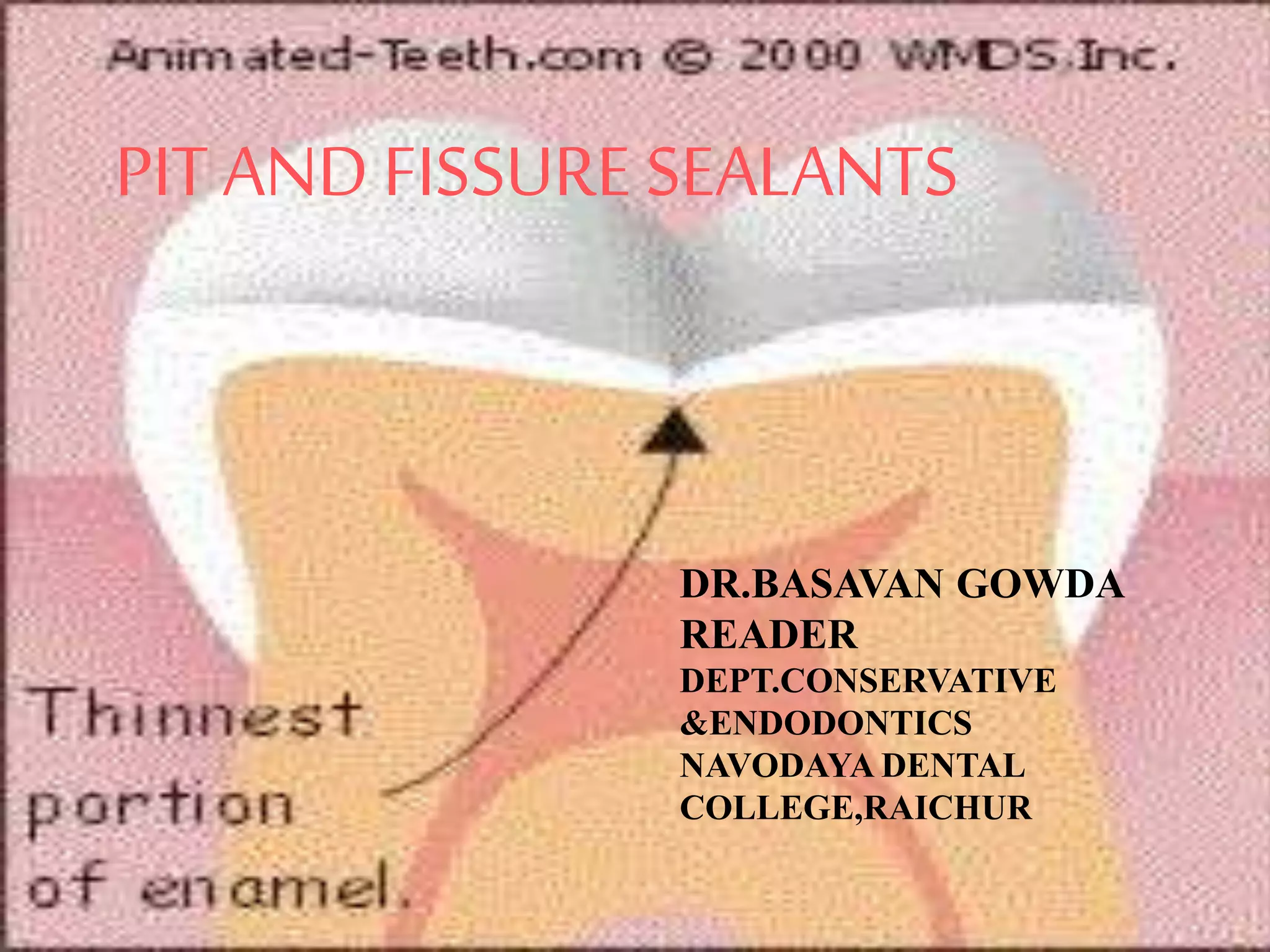 PIT AND FISSURE SEALANTS 1.ppt