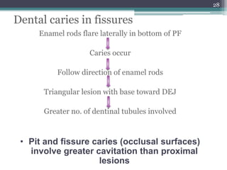 Pit and fissure sealant shabzz | PPTX