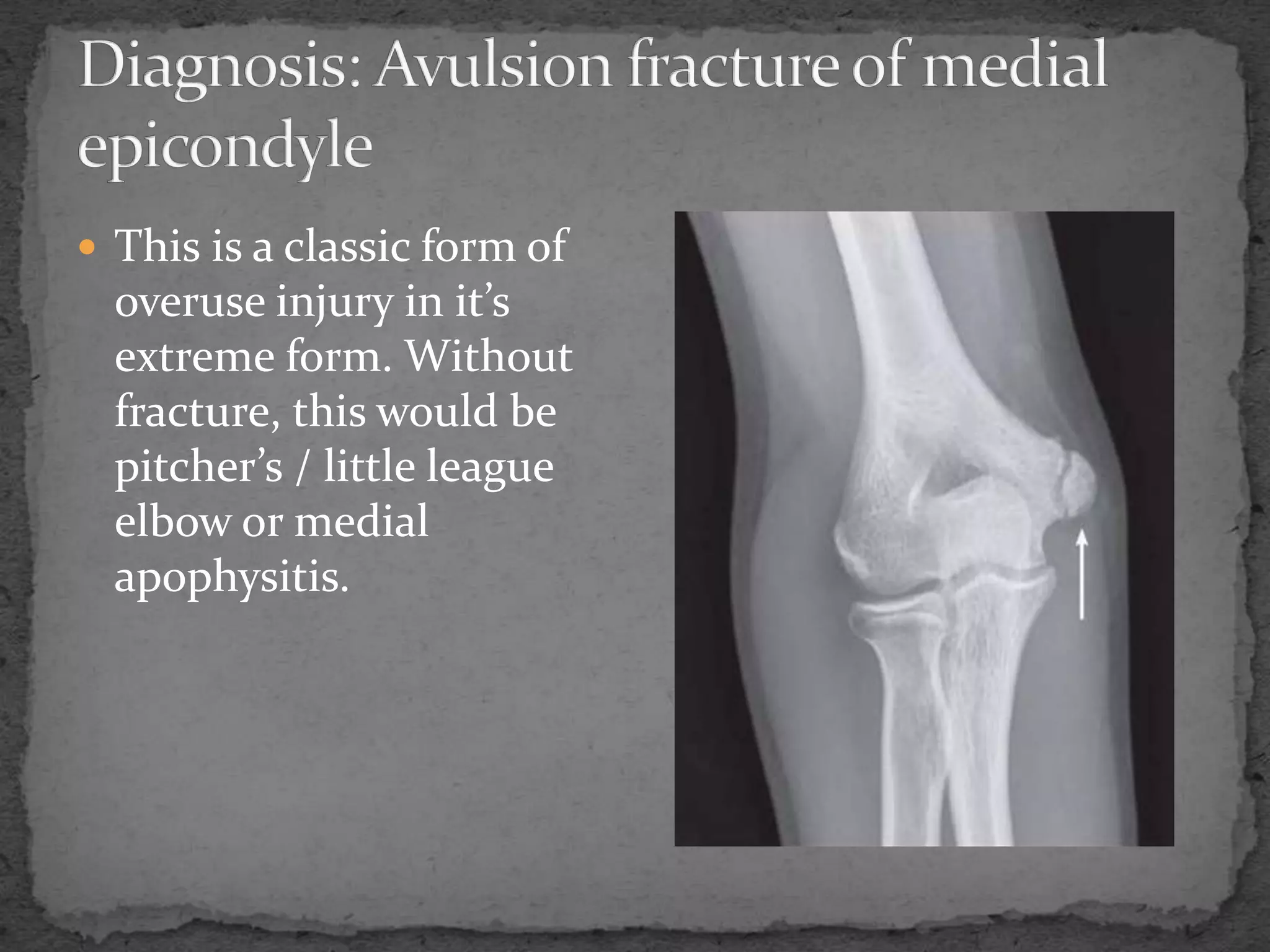 Pitcher's Elbow Power Point | PPTX