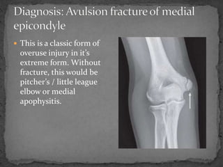 Pitcher's Elbow Power Point | PPTX