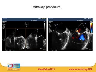Pitfalls of mitral valve repair | PDF