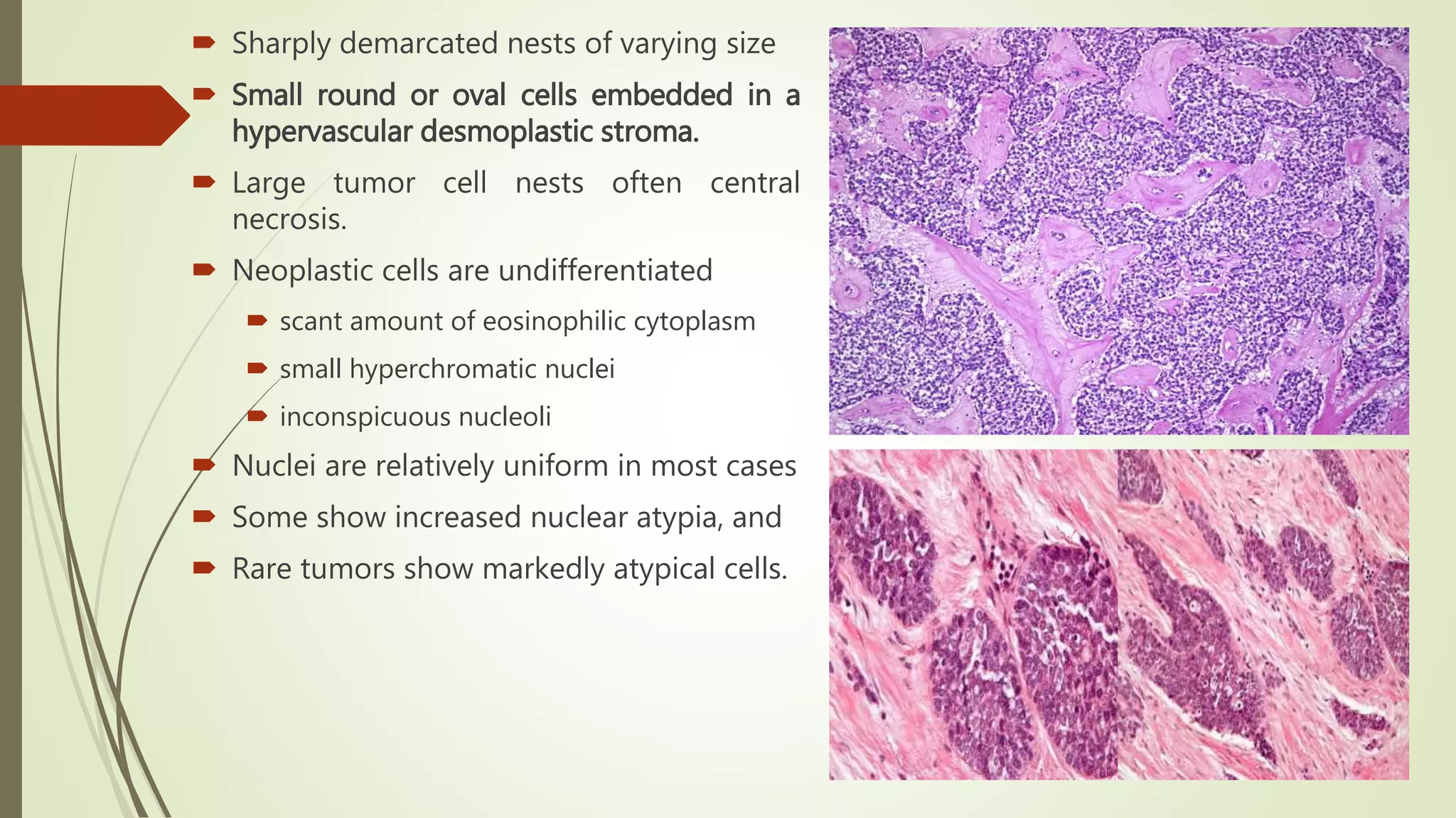 Pitfalls in diagnosis of soft tissue tumors of childhood | PPTX ...