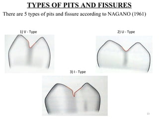 Pit & fissure sealants | PPT
