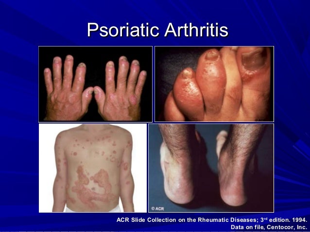 Arthritis manifestation and management