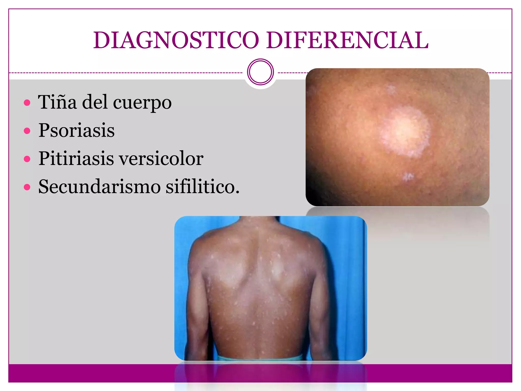 Pitiriasis rosada-1223816048320471-8 | PPTX