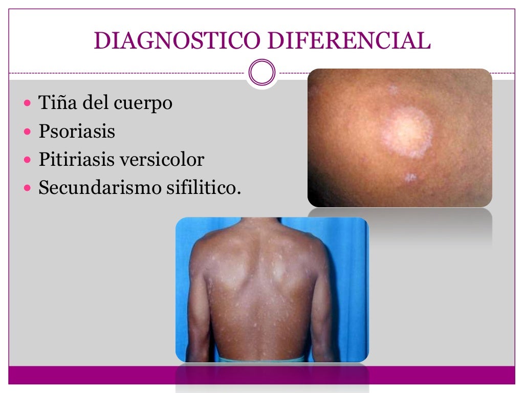 Pitiriasis rosada-1223816048320471-8