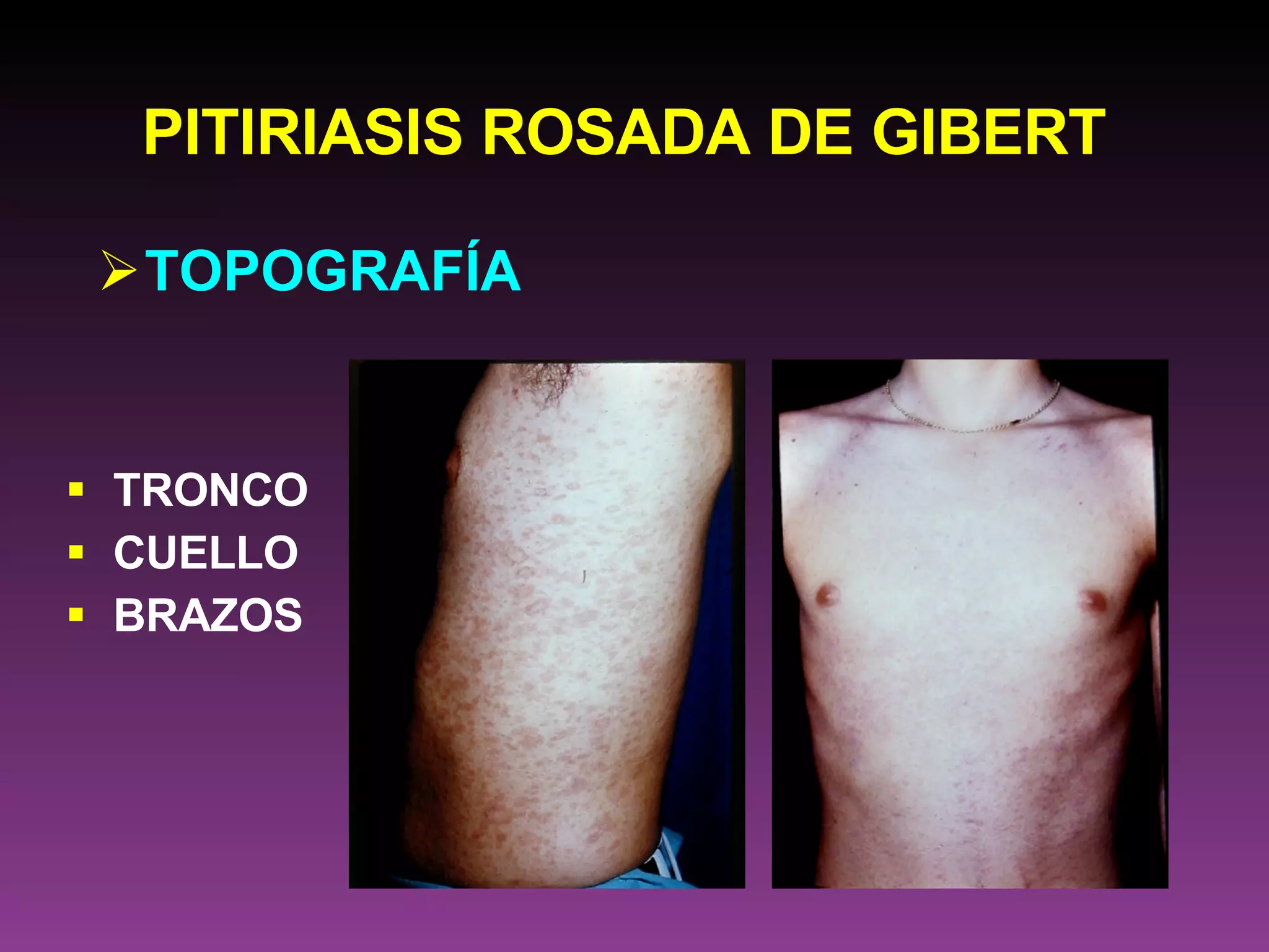 Pitiriasis Rosada De Gibert Dra Rivera | PPT