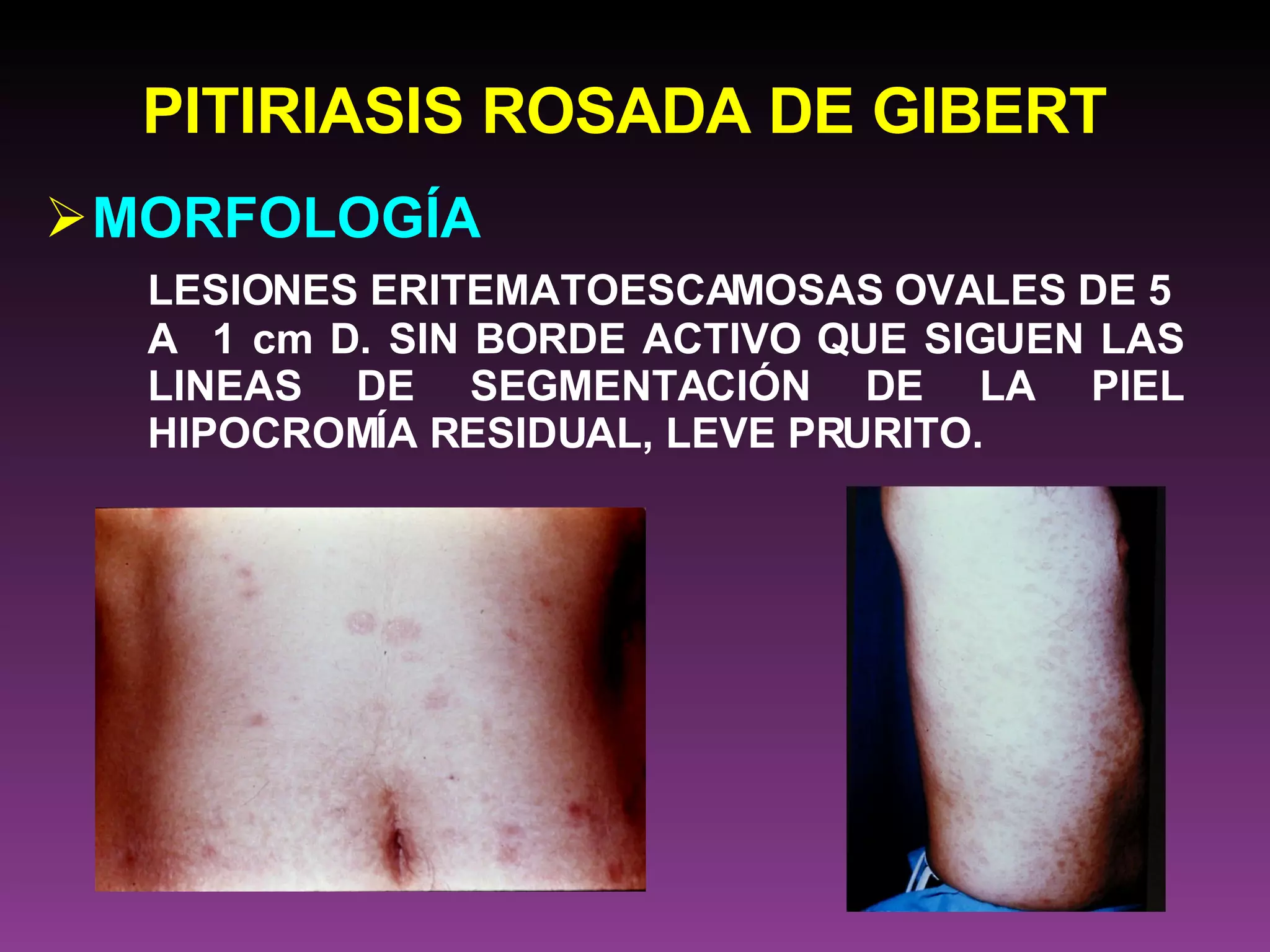 Pitiriasis Rosada De Gibert Dra Rivera | PPT