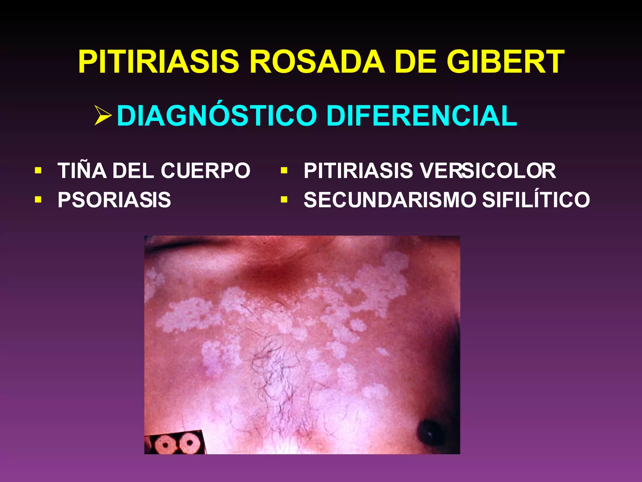 Pitiriasis Rosada De Gibert Dra Rivera | PPT