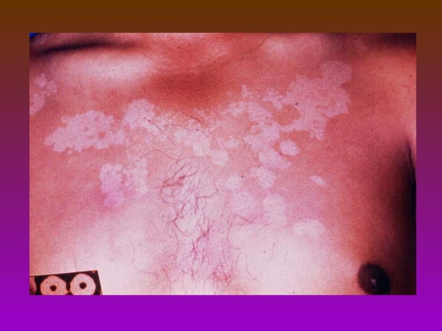 Pitiriasis Versicolor