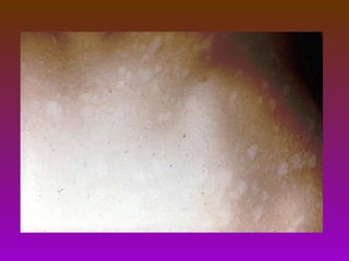 Pitiriasis Versicolor | PPT