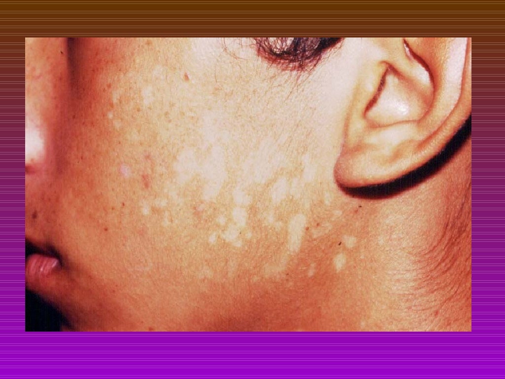 Pitiriasis Versicolor