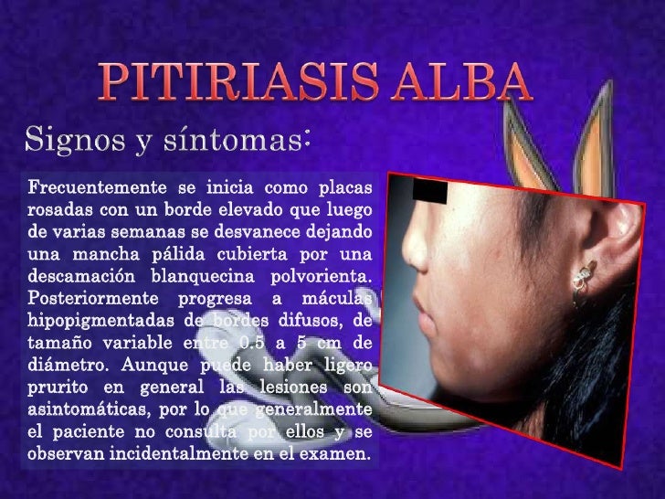 Pitiriasis Alba