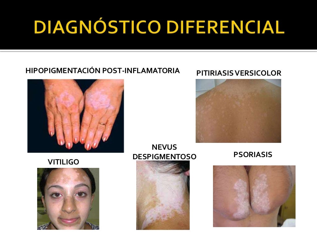 Pitiriasis alba