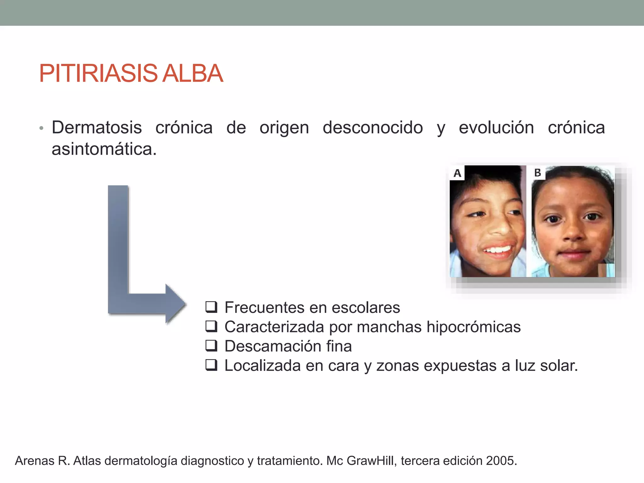 Pitiriasis Alba Ppt
