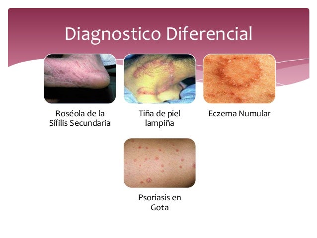 Pitiriasis rosada