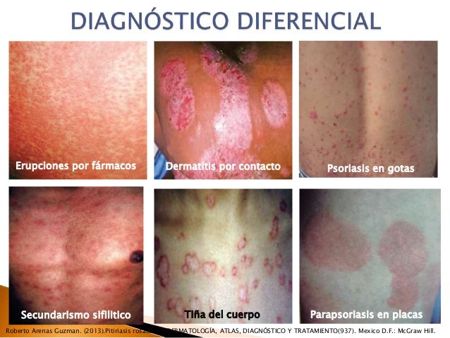 Pitiriasis Rosada de Gilbert