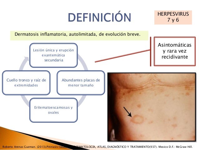 Pitiriasis Rosada de Gilbert
