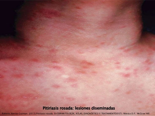 Pitiriasis Rosada de Gilbert