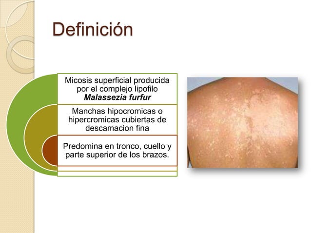 Pitiriasis versicolor | PPTX