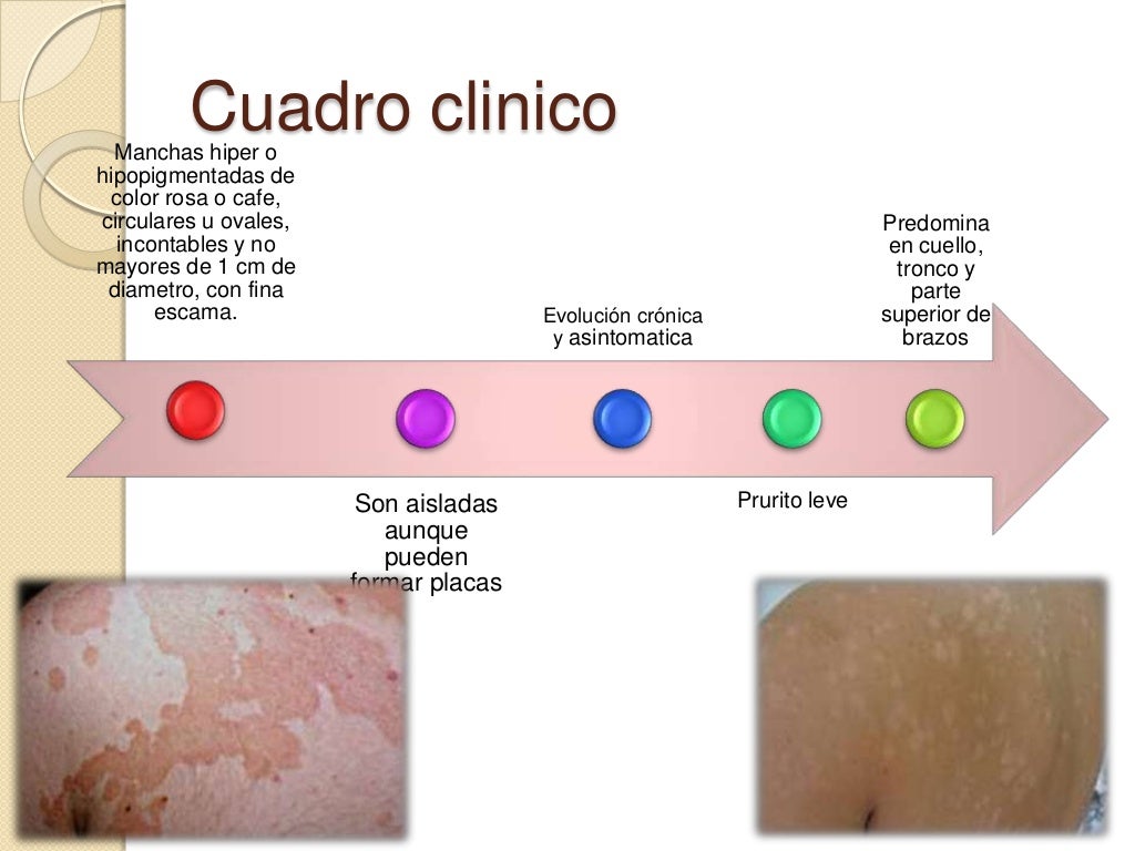 Pitiriasis versicolor