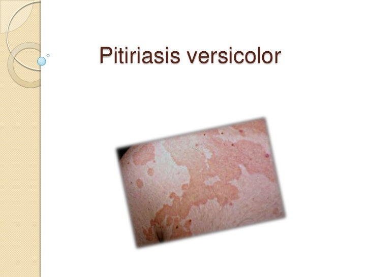 Pitiriasis versicolor