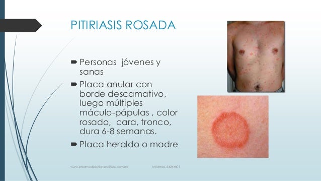 Pitiriasis versicolor