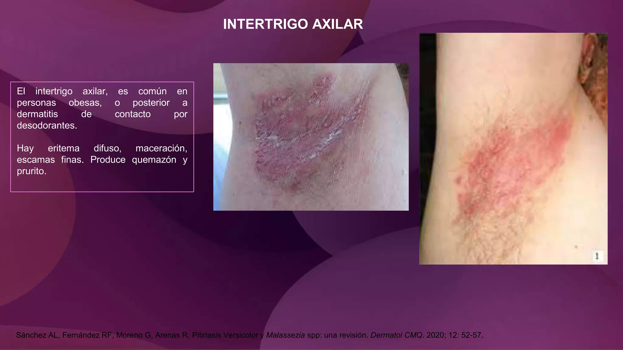 PITIRIASIS VERSICOLOR Y CANDIDIASIS.pptx