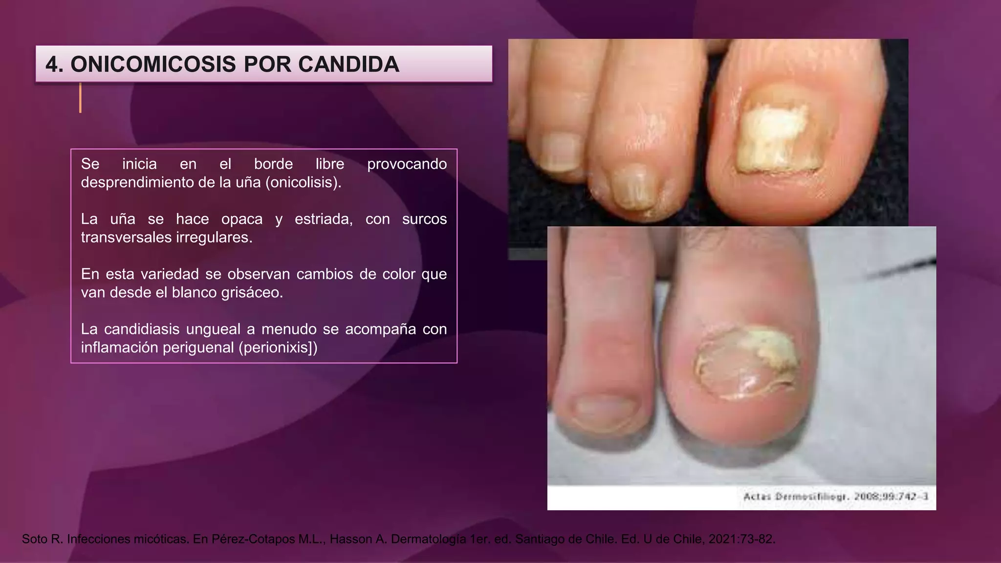 PITIRIASIS VERSICOLOR Y CANDIDIASIS.pptx