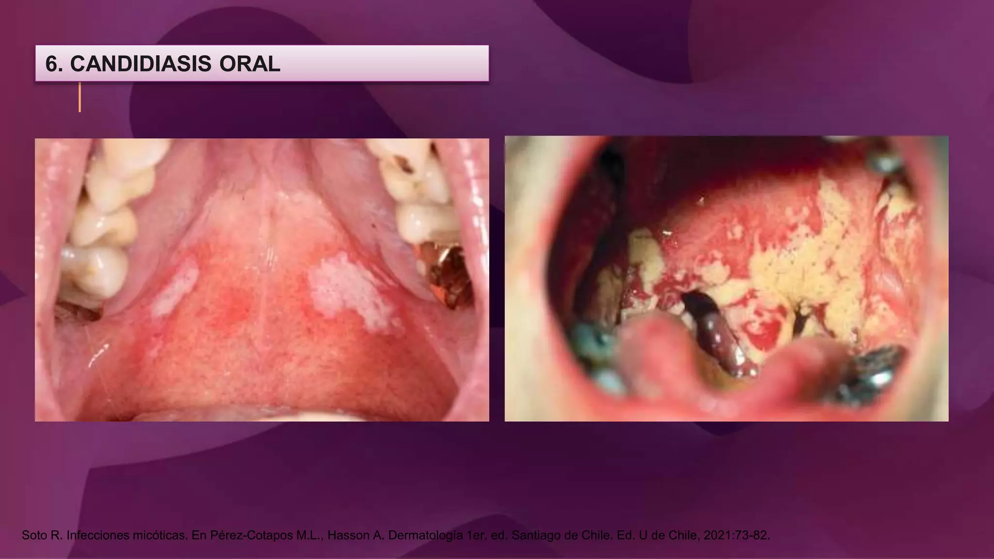 PITIRIASIS VERSICOLOR Y CANDIDIASIS.pptx