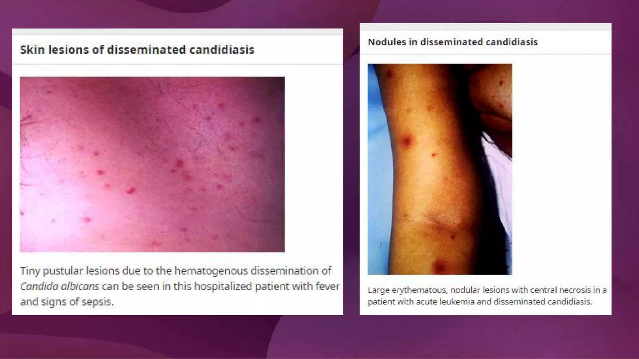 PITIRIASIS VERSICOLOR Y CANDIDIASIS.pptx