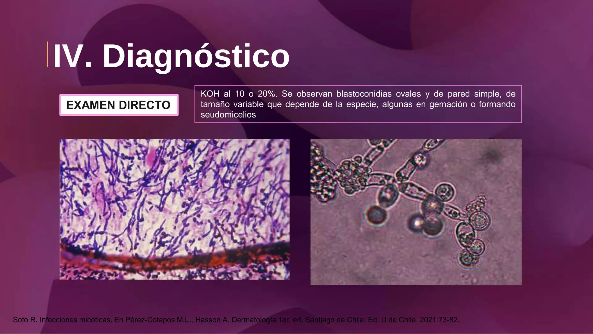PITIRIASIS VERSICOLOR Y CANDIDIASIS.pptx | Descarga Gratuita