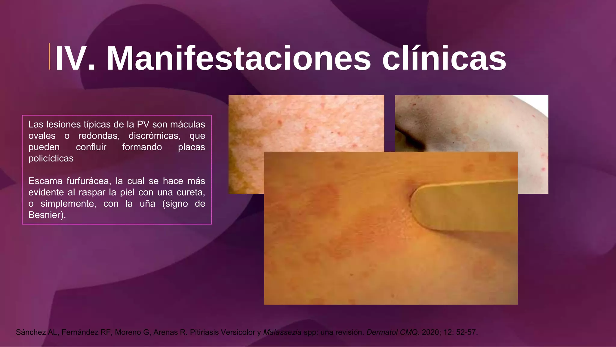 PITIRIASIS VERSICOLOR Y CANDIDIASIS.pptx