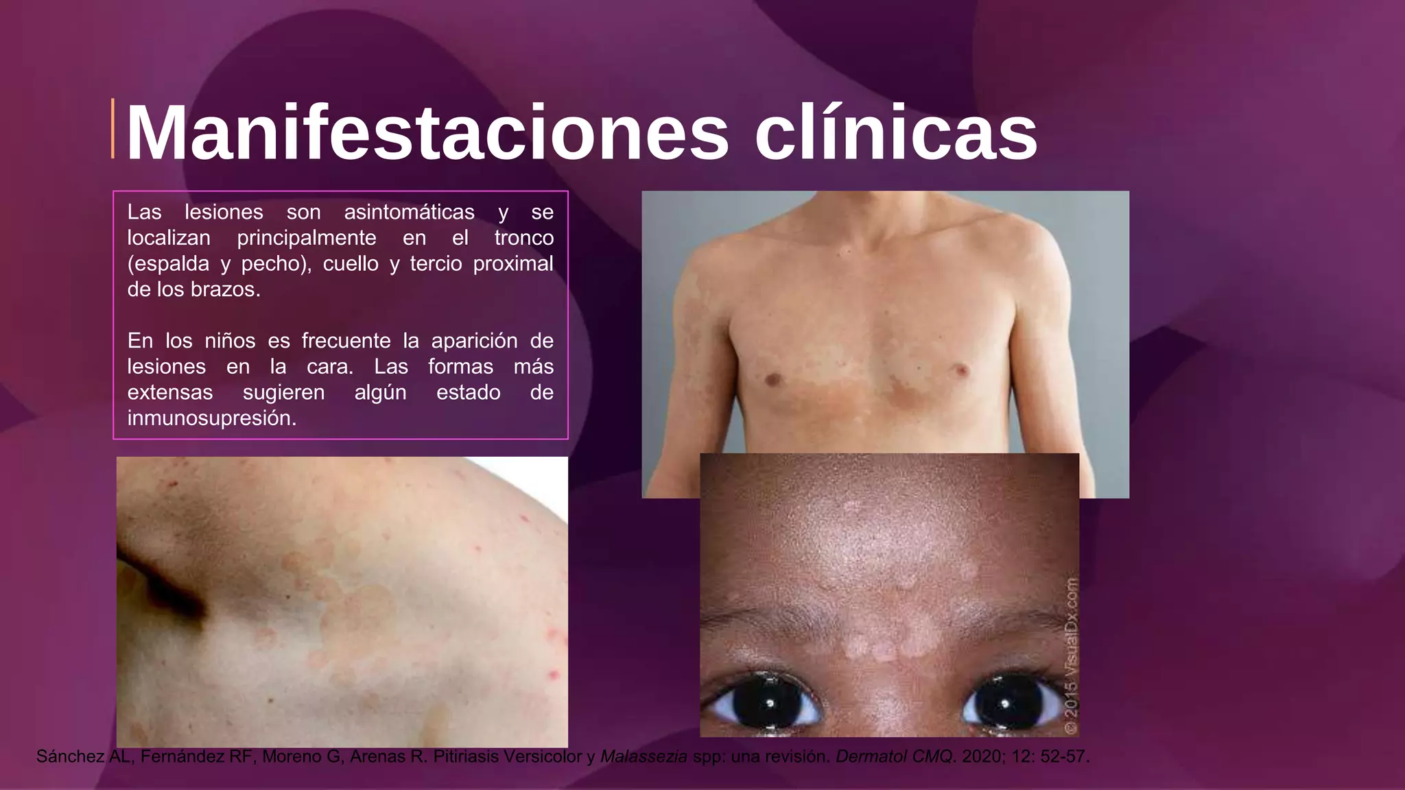 PITIRIASIS VERSICOLOR Y CANDIDIASIS.pptx