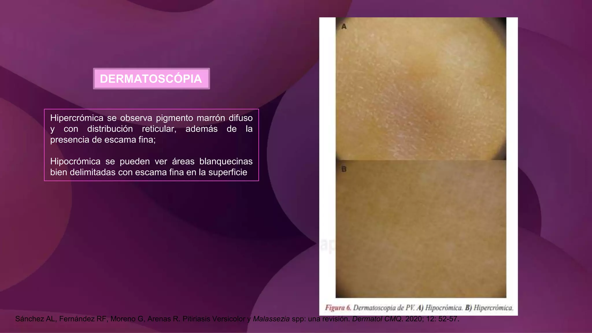 PITIRIASIS VERSICOLOR Y CANDIDIASIS.pptx