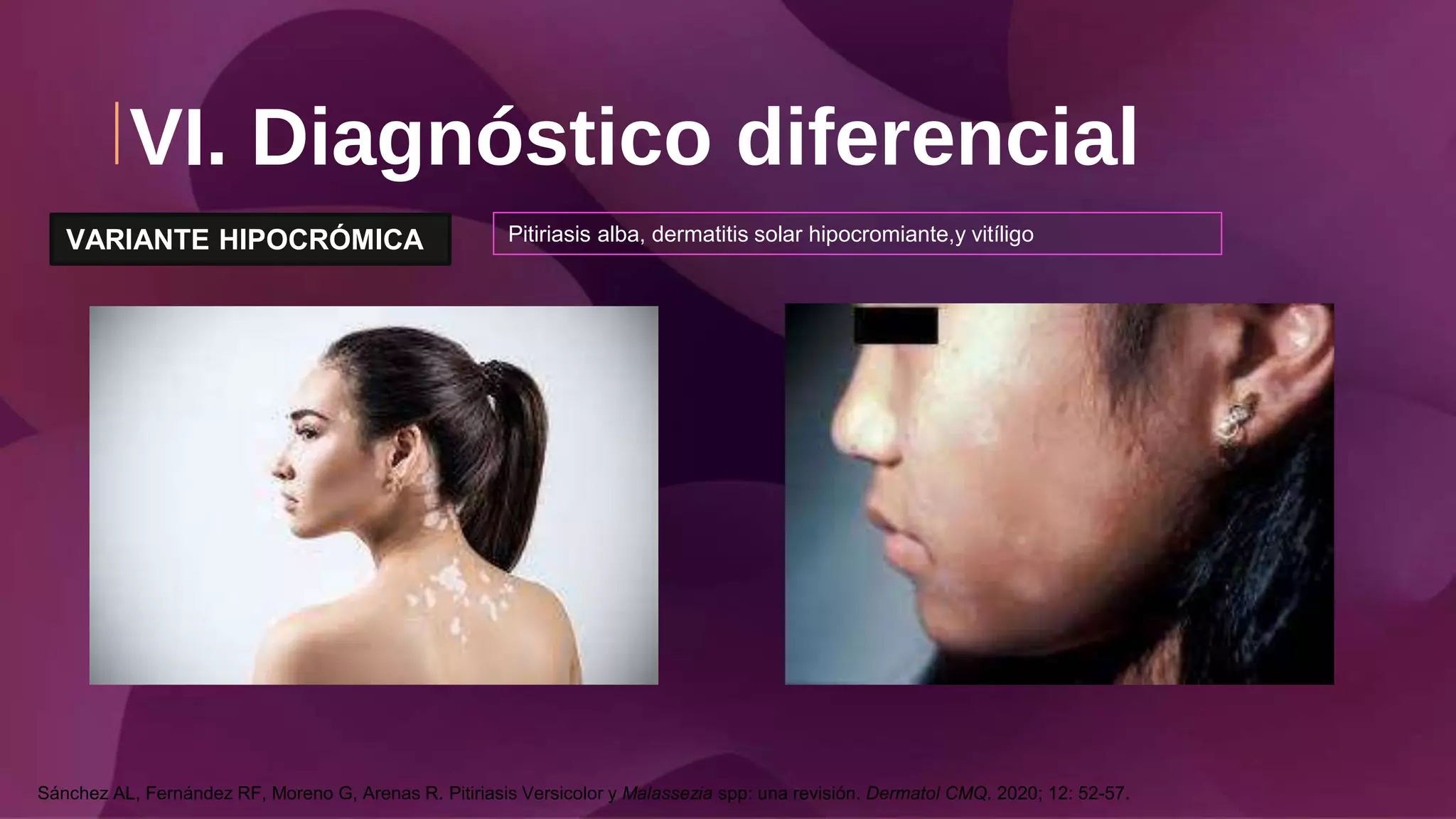 PITIRIASIS VERSICOLOR Y CANDIDIASIS.pptx