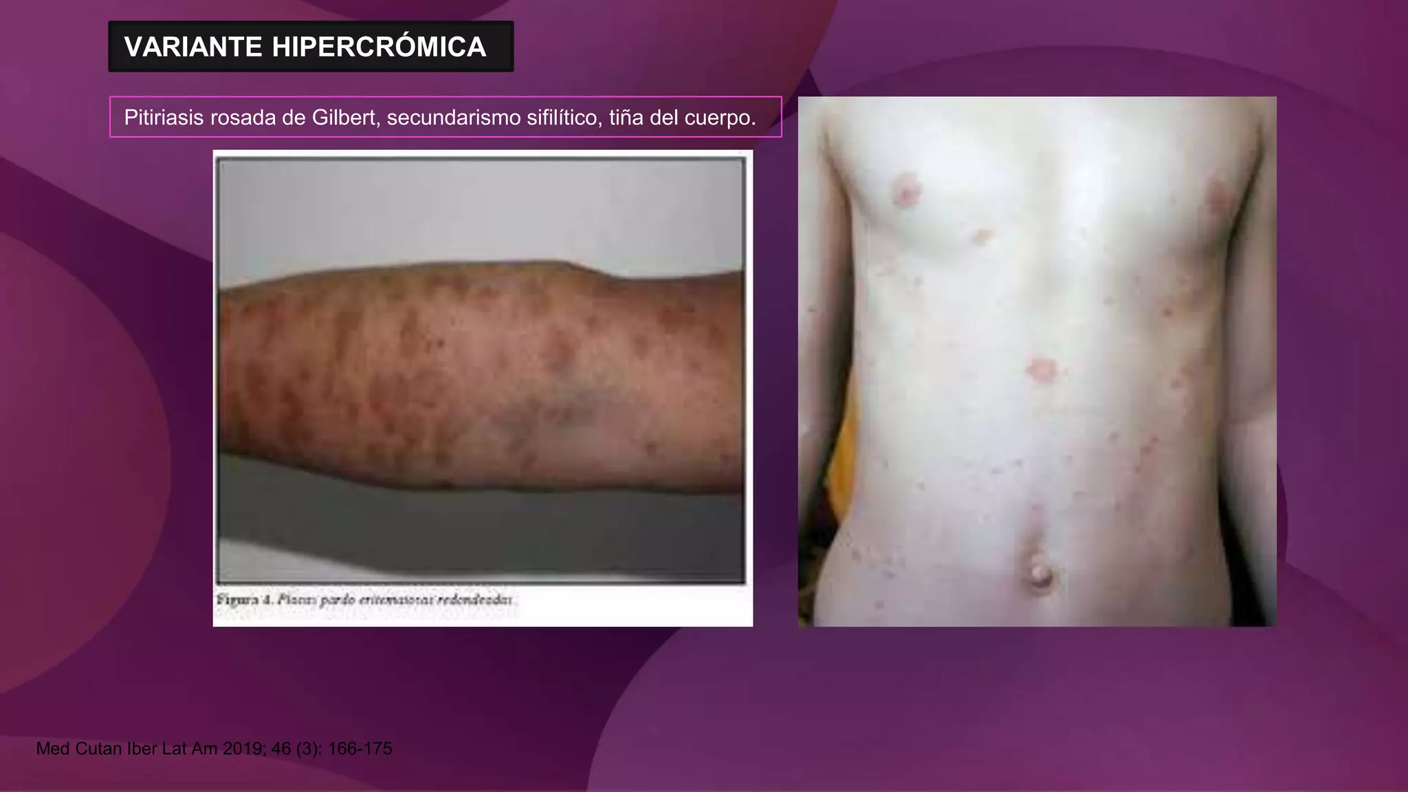 PITIRIASIS VERSICOLOR Y CANDIDIASIS.pptx | Descarga Gratuita