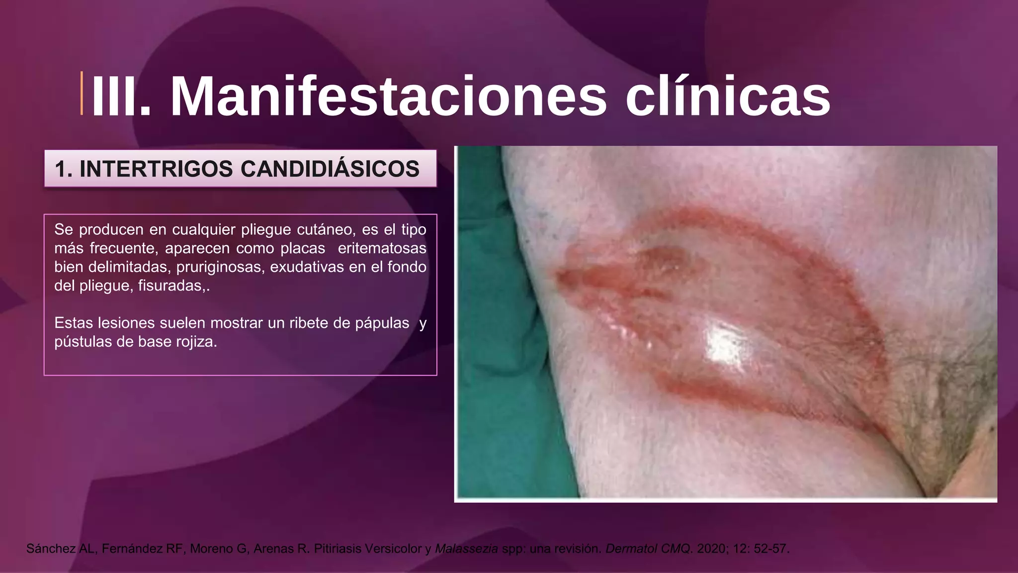 PITIRIASIS VERSICOLOR Y CANDIDIASIS.pptx