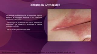 PITIRIASIS VERSICOLOR Y CANDIDIASIS.pptx
