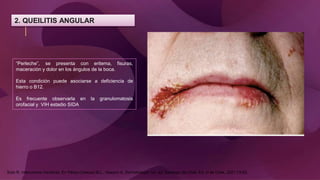 PITIRIASIS VERSICOLOR Y CANDIDIASIS.pptx