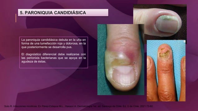 PITIRIASIS VERSICOLOR Y CANDIDIASIS.pptx