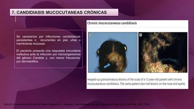 PITIRIASIS VERSICOLOR Y CANDIDIASIS.pptx