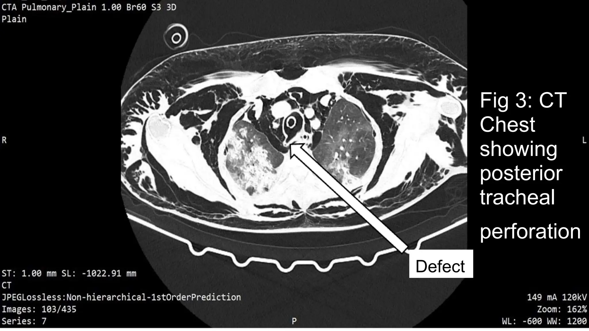 Post Intubation Tracheal Laceration.pptx