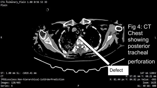 Post Intubation Tracheal Laceration.pptx