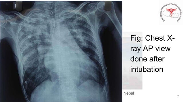 Post Intubation Tracheal Laceration.pptx