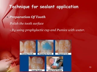 pit and fissure sealants used in dentistry | PPT