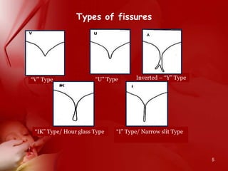 pit and fissure sealants used in dentistry | PPT