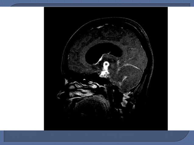 A Case of TB meningitis with Pituitary TB | PPT